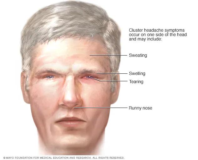 Dolor De Cabeza En Racimo: Todo Lo Que Necesitas Saber | Doctor Online
