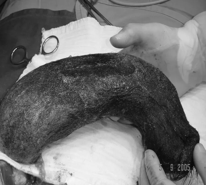 Tricobezoar: Causas, Síntomas, Diagnóstico Y Tratamiento | Doctor Online