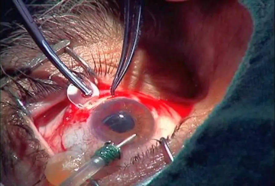 Microcirugía Ocular Para Mejorar Tu Visión | Doctor Online