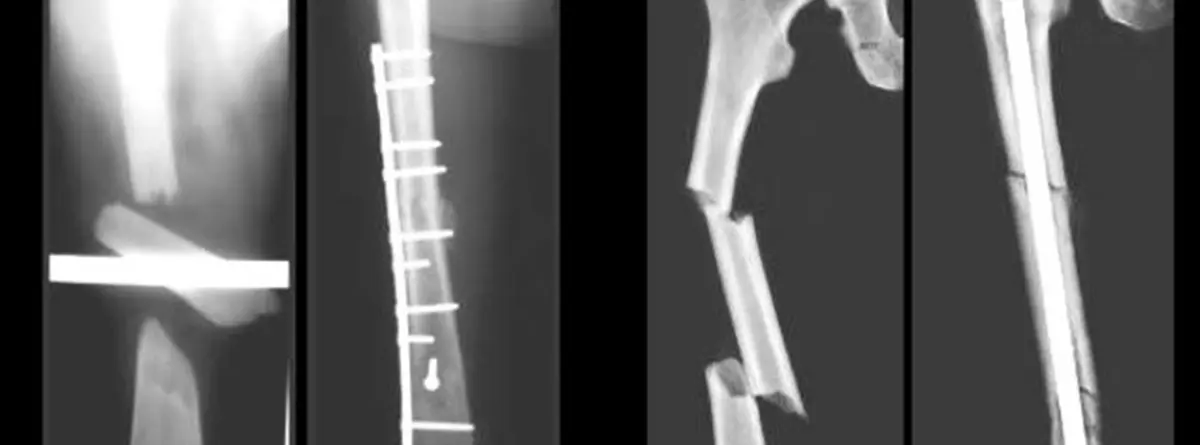 Osteosíntesis: Todo Lo Que Necesitas Saber | Doctor Online
