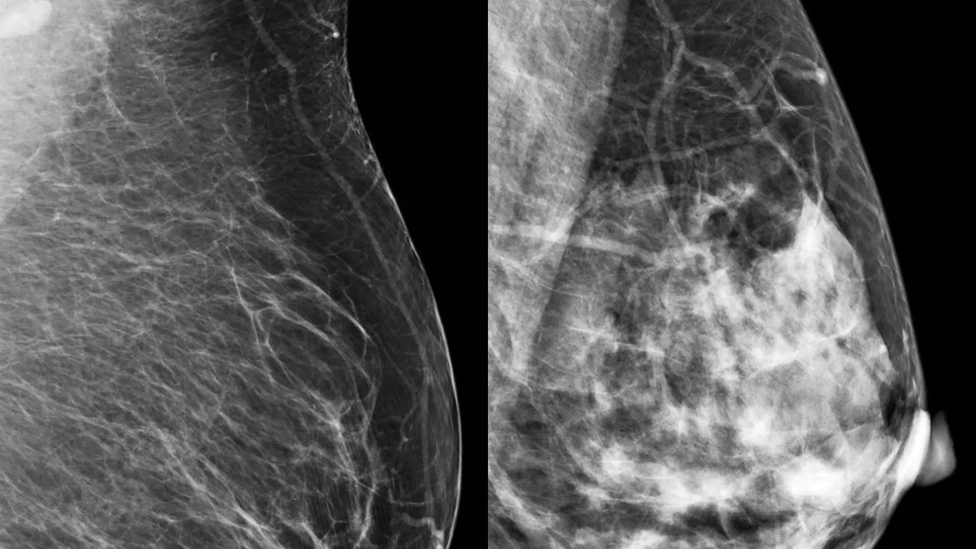 Mamás Densas: ¿Dolor Y Riesgo De Cáncer? | Doctor Online