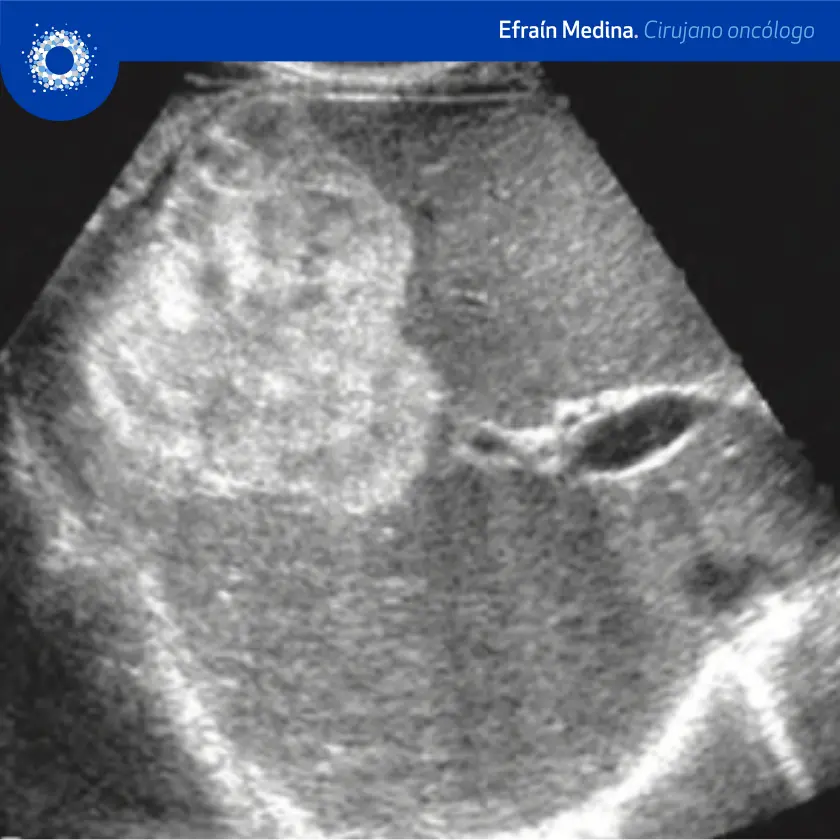 Hemangioma Hepático: Diagnóstico Y Manejo Con Ecografía | Doctor Online