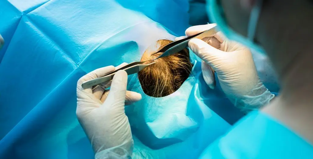 Tipos De Alopecia: Causas, Diagnóstico Y Tratamiento | Doctor Online