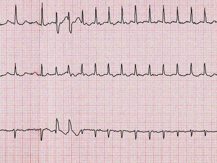 Palpitaciones Cardíacas: Causas, Síntomas Y Tratamientos | Doctor Online