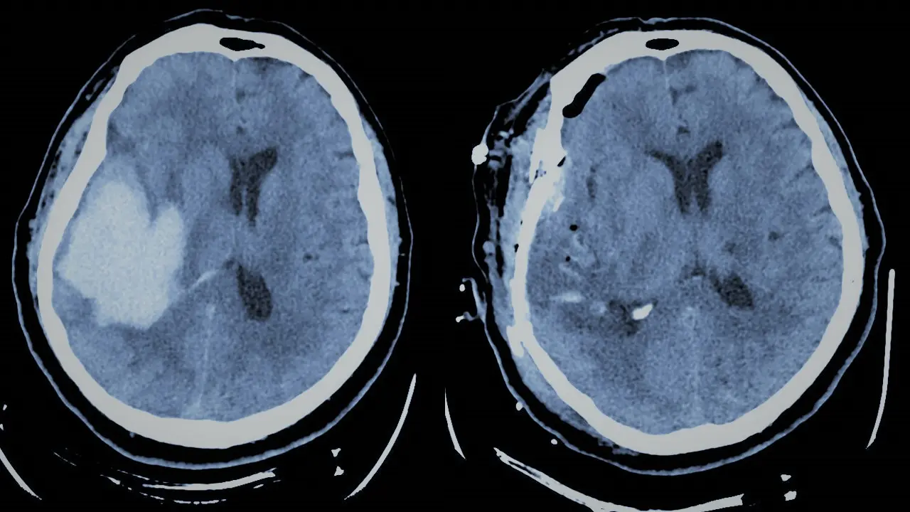 Hemorragia Cerebral: Causas, Síntomas, Tratamiento Y Recuperación ...