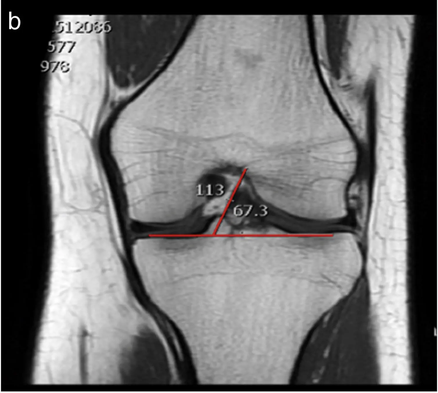 Ligamento Cruzado Anterior: Diagnóstico Con Resonancia Magnética ...