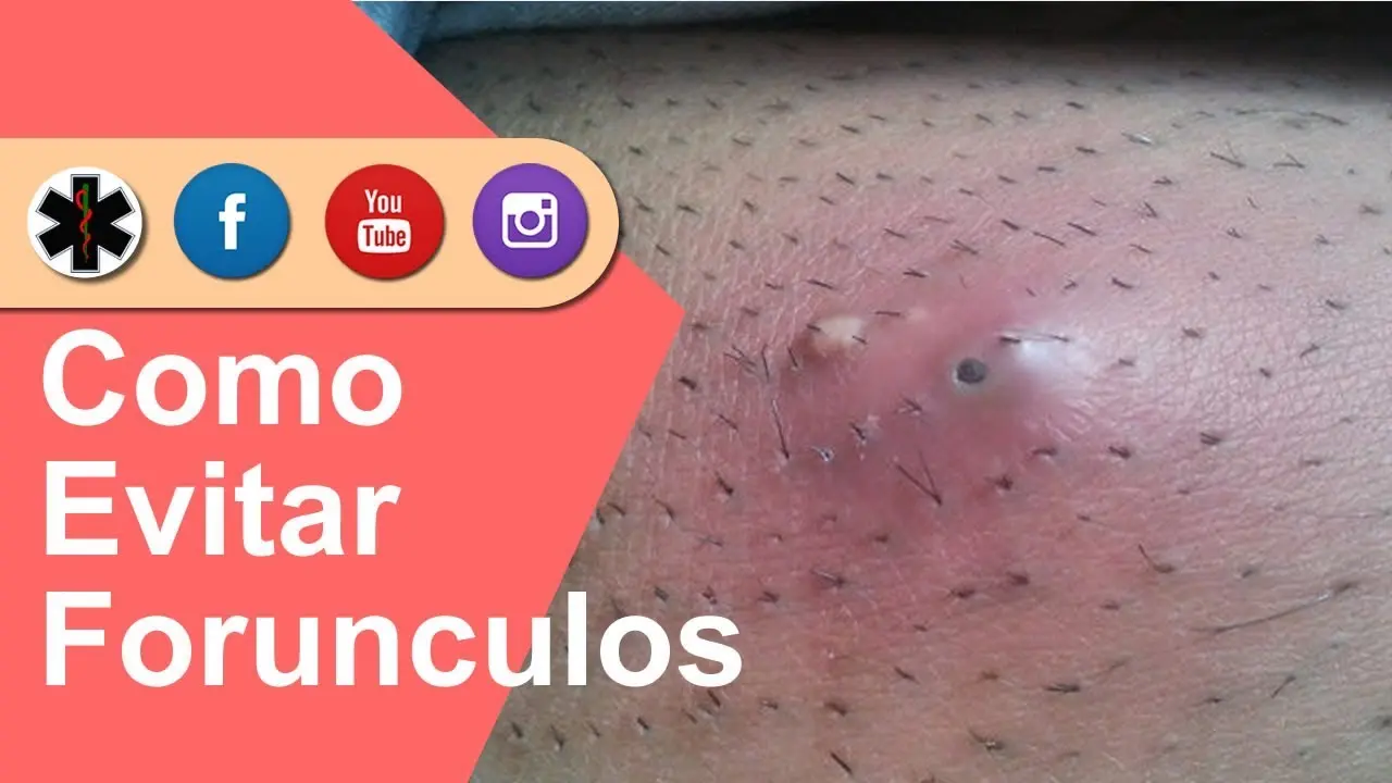 Forúnculos: Cómo Tratarlos Y Prevenir Su Aparición | Doctor Online