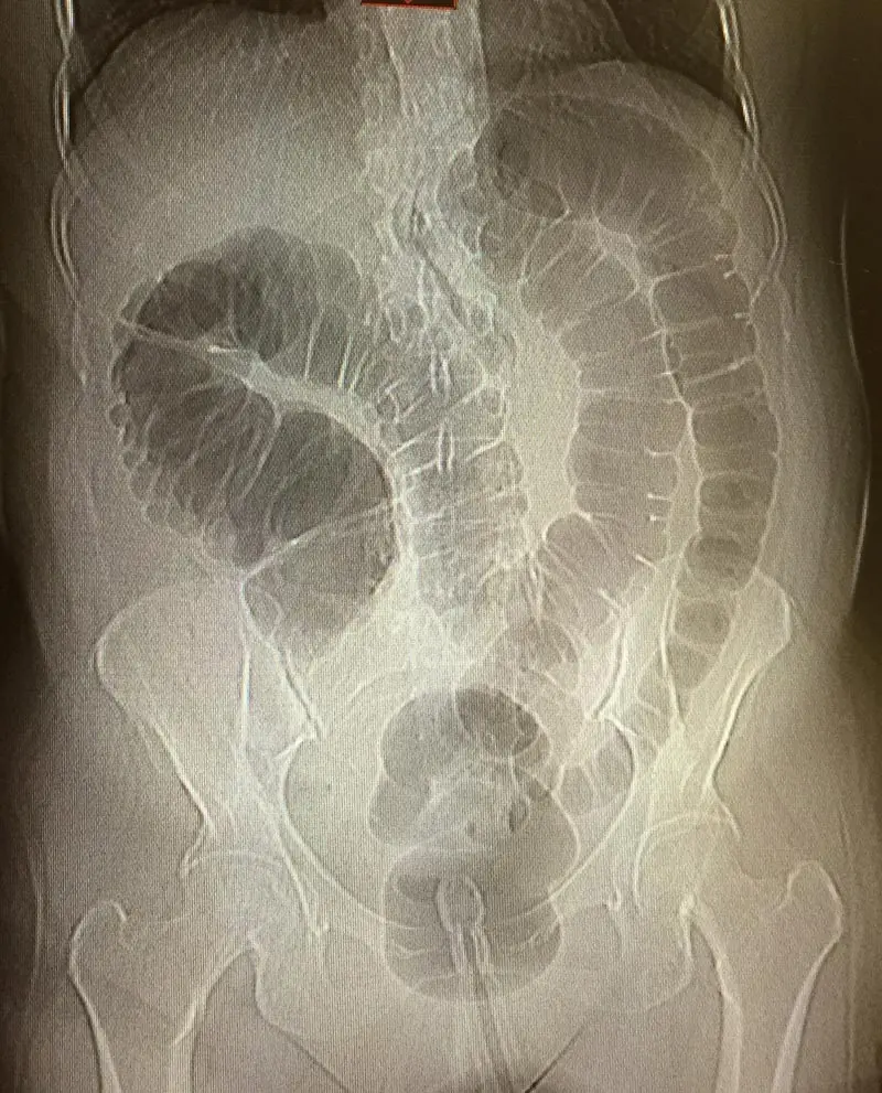 Dolicomegacolon Andino: Causas, Síntomas Y Tratamiento | Doctor Online