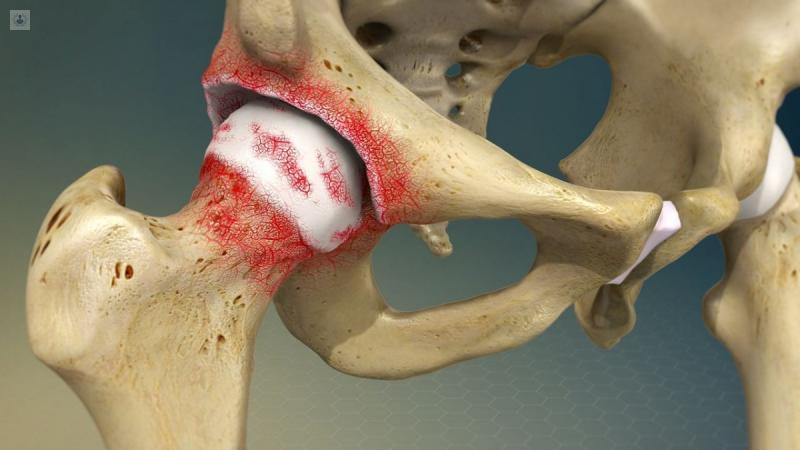 Osteoartrosis: Qué Es, Síntomas Y Tratamiento – SXEYQX