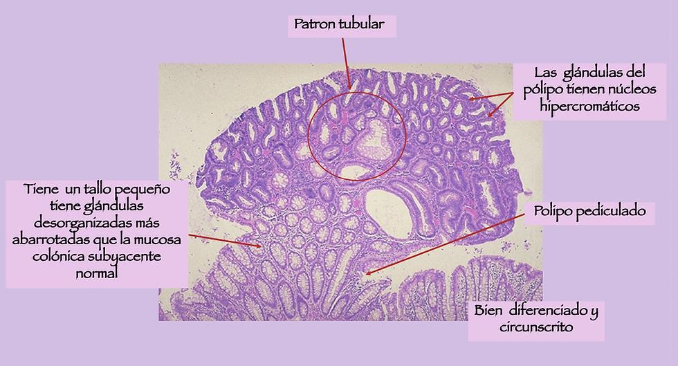 Diferencias Entre Pólipo Y Adenoma | Doctor Online