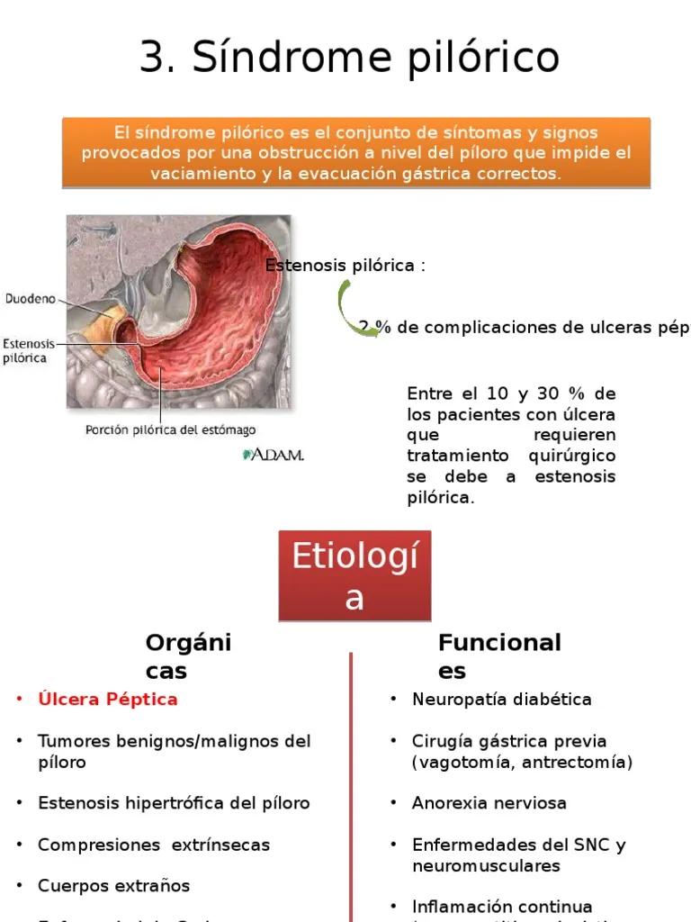 Síndrome Del Píloro En Adultos: Causas, Síntomas, Diagnóstico Y ...