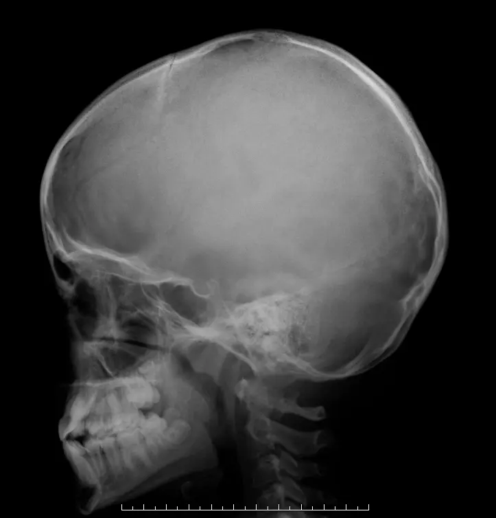 Radiografía De Cráneo | Doctor Online