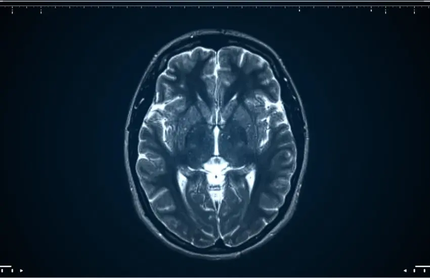 Resonancia Magnética Cerebral: Cómo Interpretar Los Resultados | Doctor ...