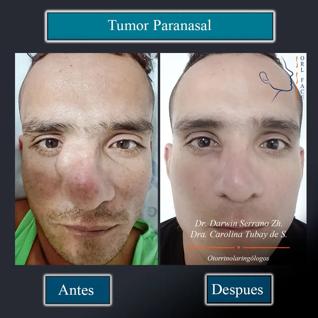 Tumor En La Nariz: Síntomas, Causas, Tratamiento Y Prevención | Doctor ...