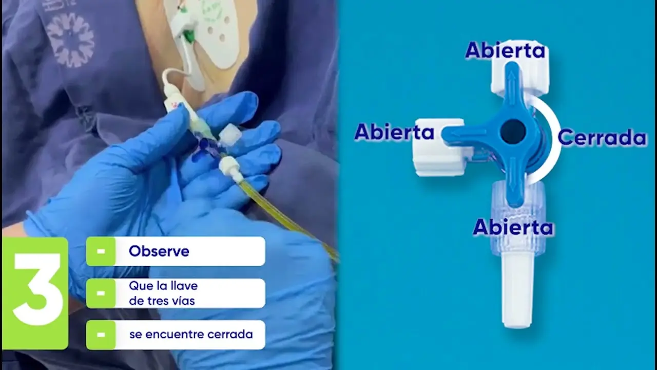 Drenaje Biliar Percutáneo: Procedimiento, Indicaciones Y Complicaciones ...