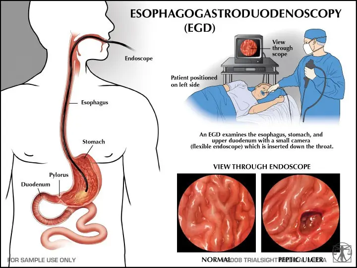 Esofagogastroduodenoscopia (egd) | Doctor Online
