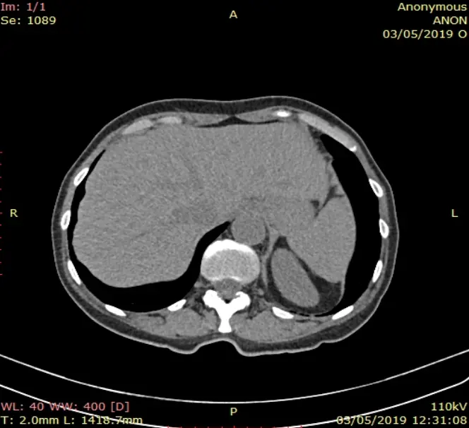 Angiografía Coronaria Por Tomografía Computarizada (angio Tc) | Doctor ...