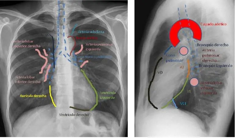 Punción Pulmonar: Diagnóstico Y Procedimientos | Doctor Online
