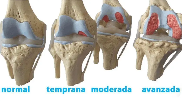 Osteoartritis: Causas, Síntomas, Tratamiento Y Prevención | Doctor Online