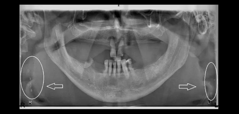 Ateroma Calcificado: Causas, Síntomas Y Tratamiento | Doctor Online