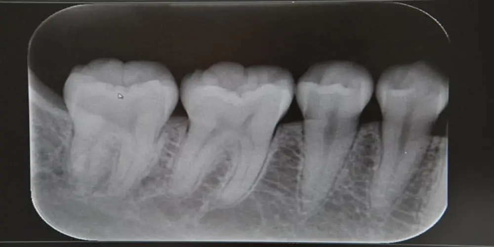Radiografía Periapical: Precio Y Todo Lo Que Debes Saber | Doctor Online