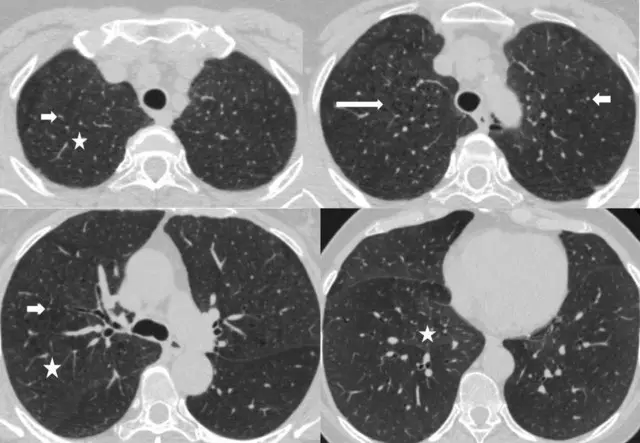 Enfisema Centrolobulillar: Causas, Síntomas Y Pronóstico | Doctor Online